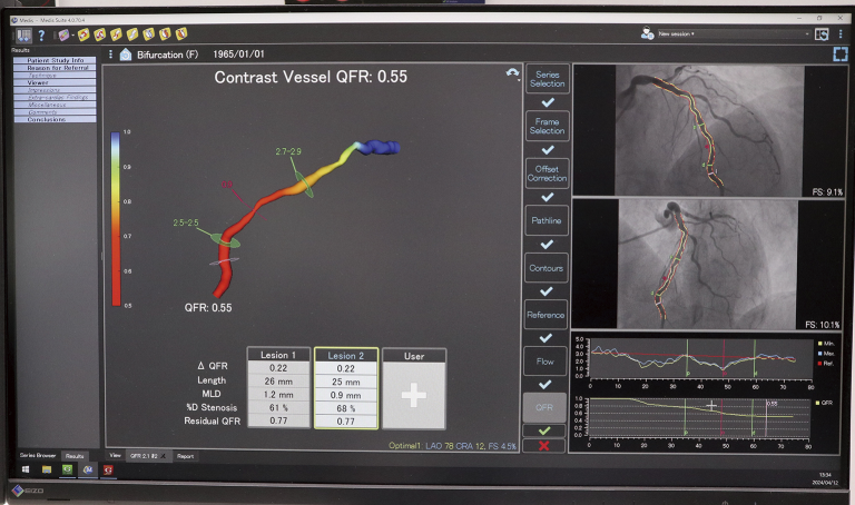 メディカルwatch » Blog Archive » 【ITEM2024取材速報】ニプロ／Medis QFR®・ECHOMO™