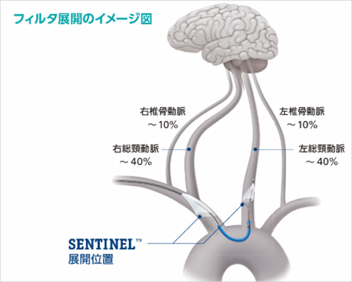 メディカルwatch » Blog Archive » ボストン・サイエンティフィックジャパン、経カテーテル的大動脈弁留置術(TAVI)向け脳 ...