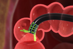 メディカルwatch » Blog Archive » オリンパス、内視鏡用先端アタッチメント「ENDOCUFF VISION」を発売